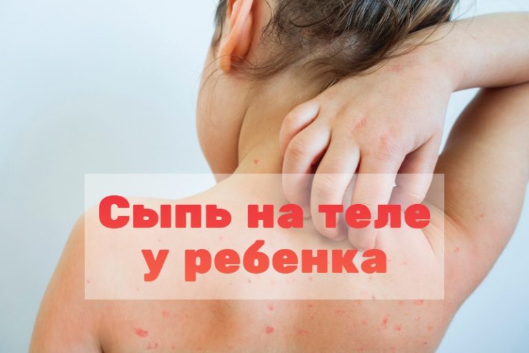 Сыпь на теле у ребенка: причины, симптомы и лечение сыпи у ребенка